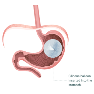 Intra Gastric Balloon Sydney | Dr. Mark Magdy