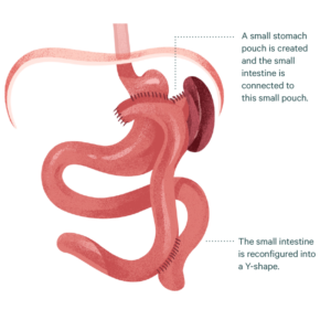 Gastric Bypass Surgery Sydney | Dr. Mark Magdy